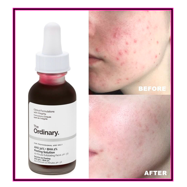 AHA 30%+ BHA 2% Peeling Solution The Ordinary – Beauty Palace